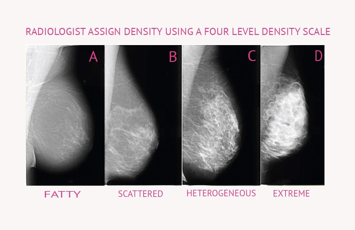 Iowa Breast Density
